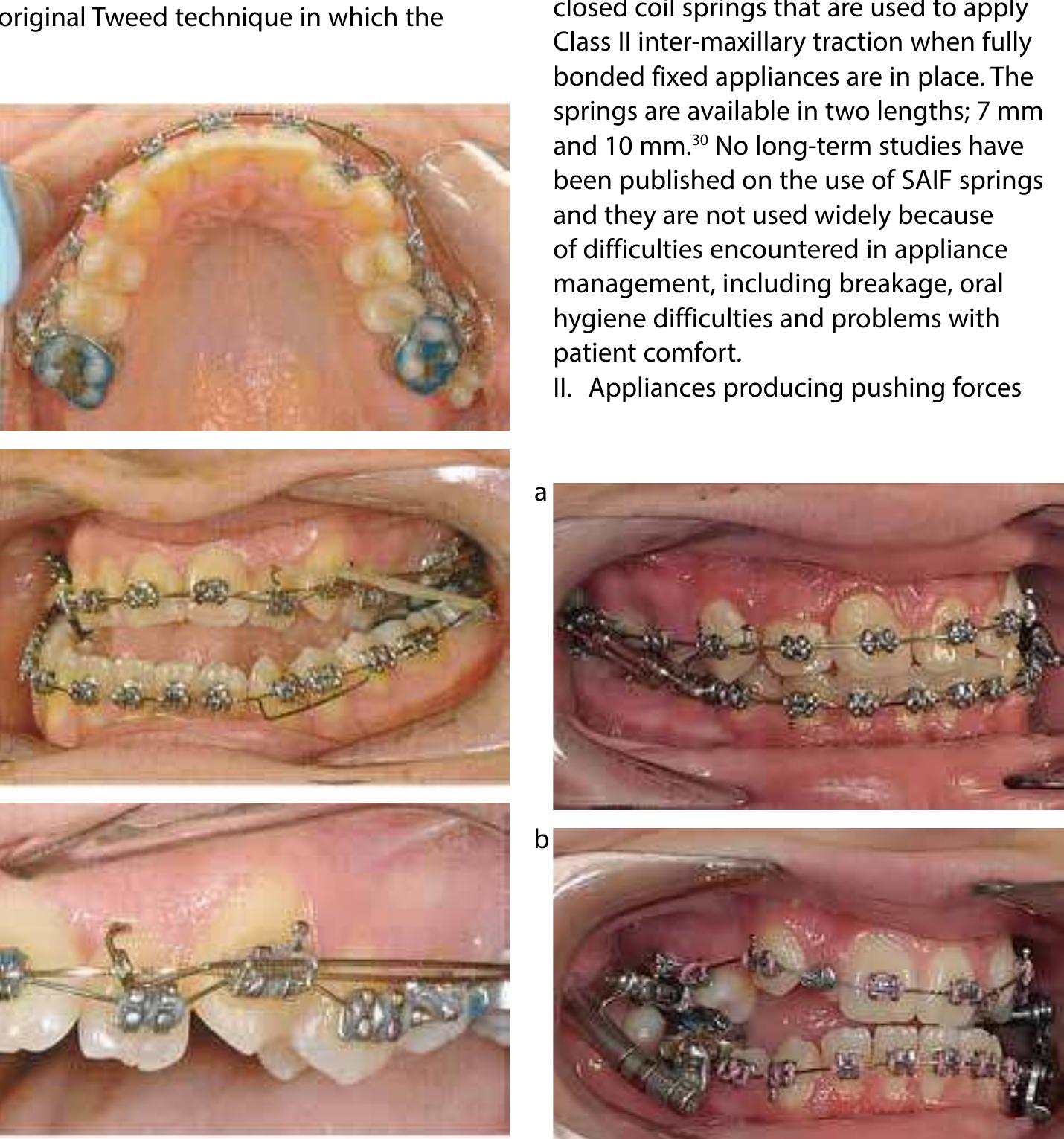 (PDF) A Review of Molar Distalisation Techniques