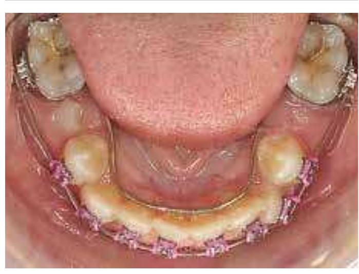 Conventional lingual arch. figure 3. nance palatal arch