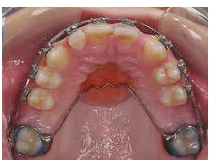 An offset nance button to accommodate the instanding lateral