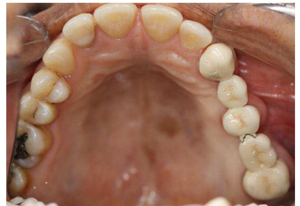 Figure 4 - from Pier abutment: Break the stress