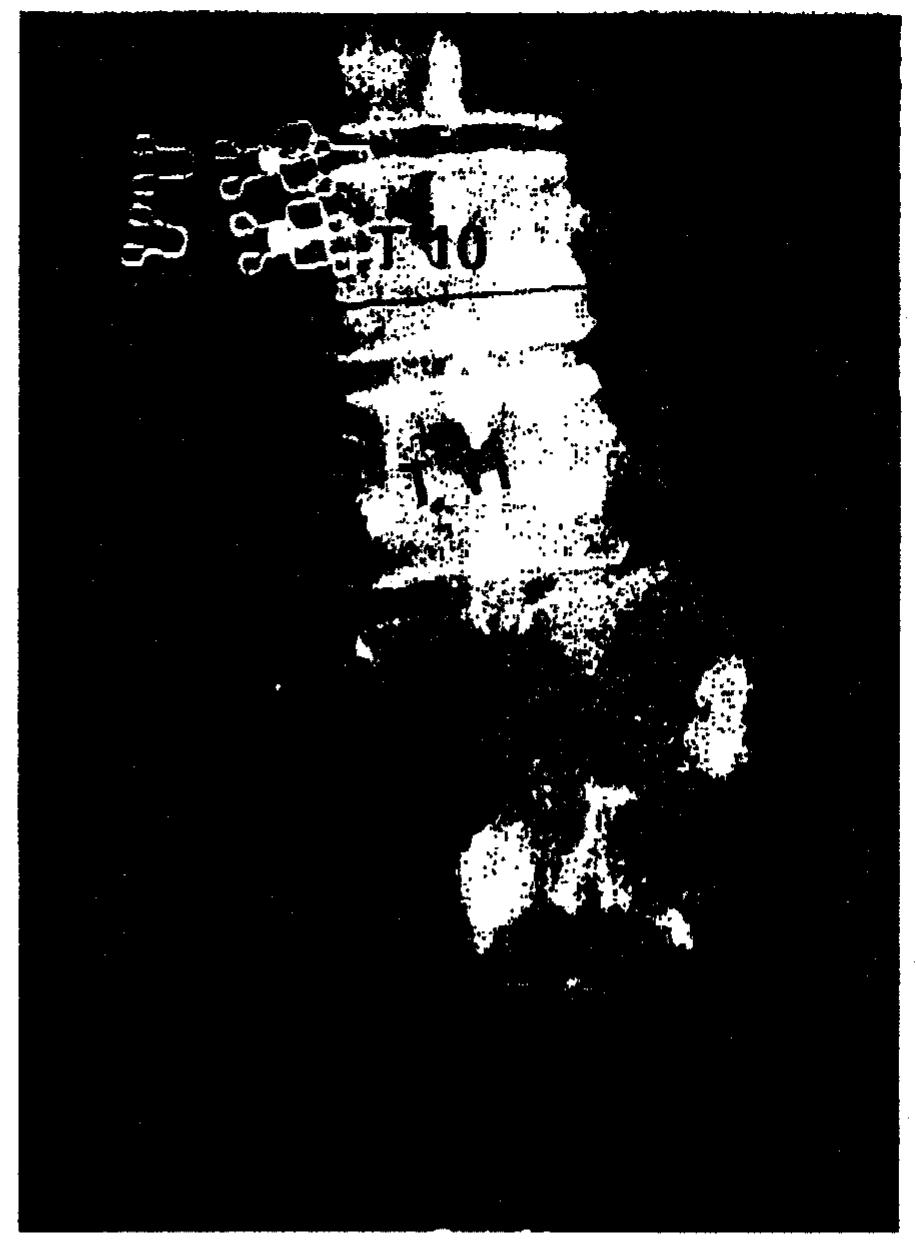 Axial view of ct thoracic spine showing the dislocation of