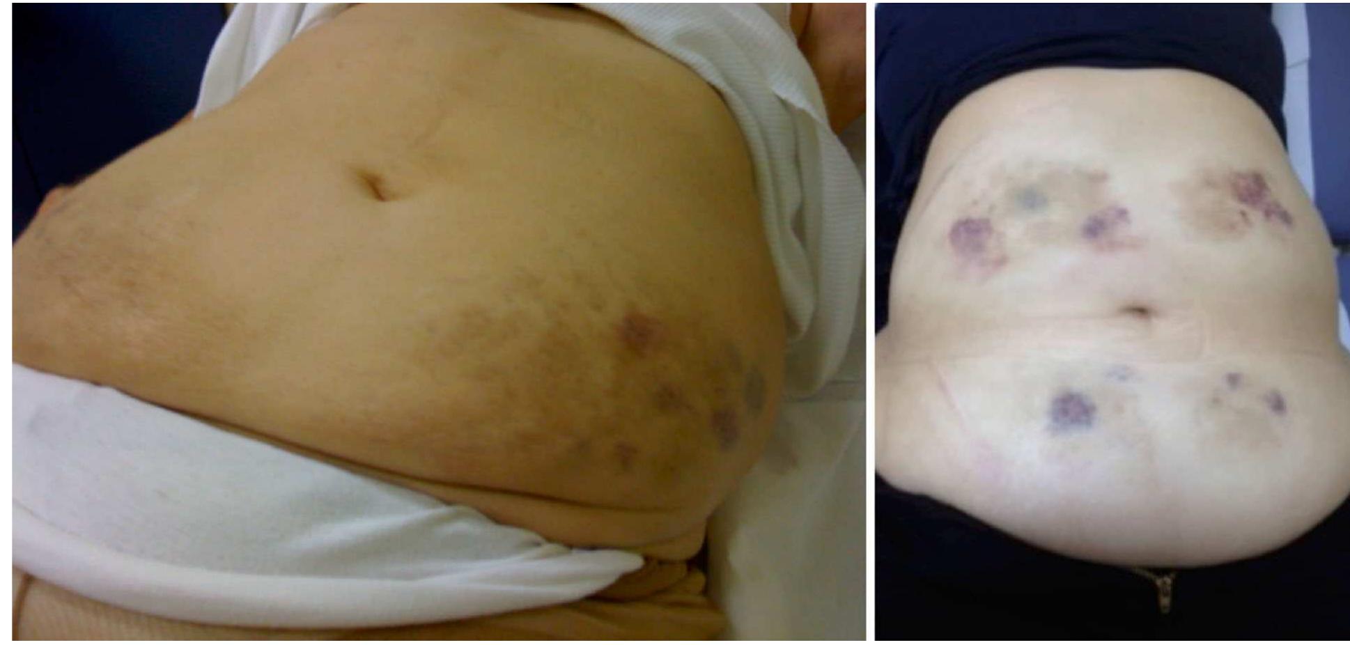 Two examples of bruising due to insulin injection, in the