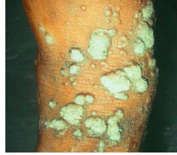 Verruca vulgaris (common warts). (photo courtesy of prof hf