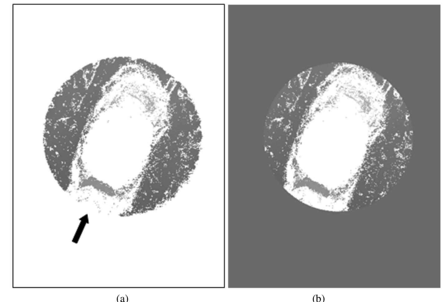 (a) example of an image with incomplete psa edge (see arrow)