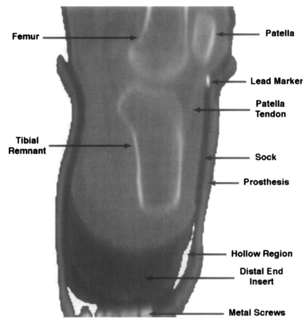 The below-knee residual limb soft tissues, bone, and