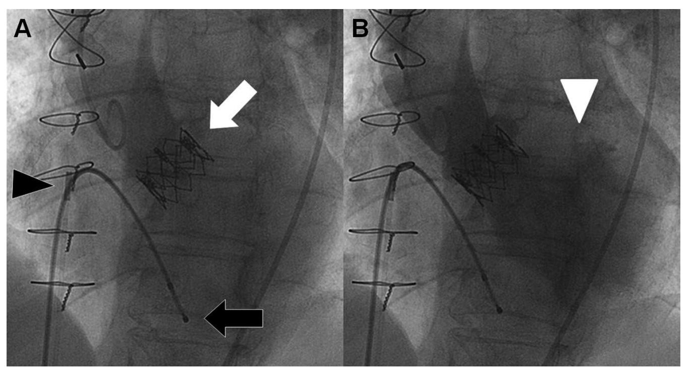 The procedure was planned through the transfemoral ap-