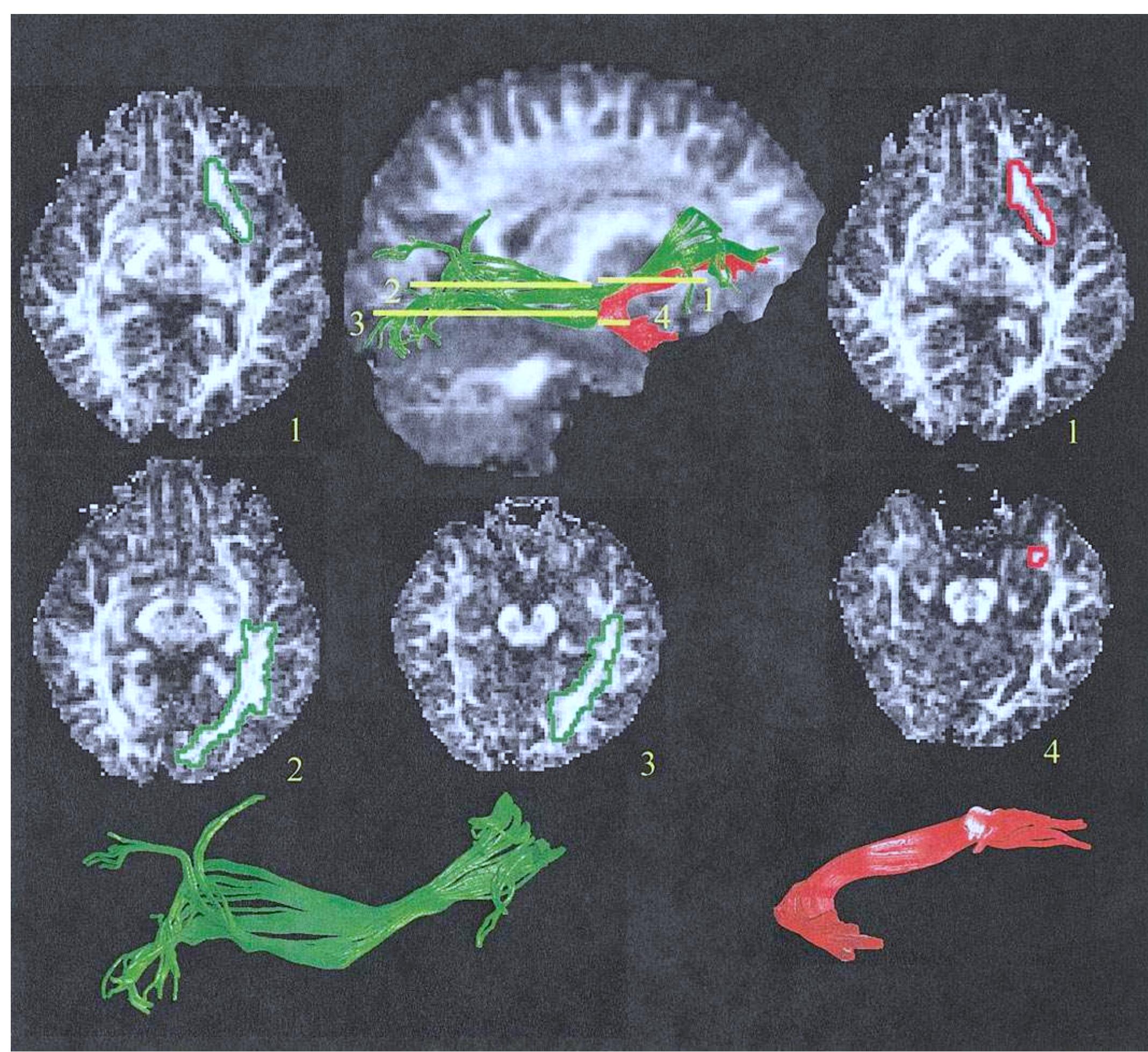 Example of “in vivo dissection” of the occipito-frontal