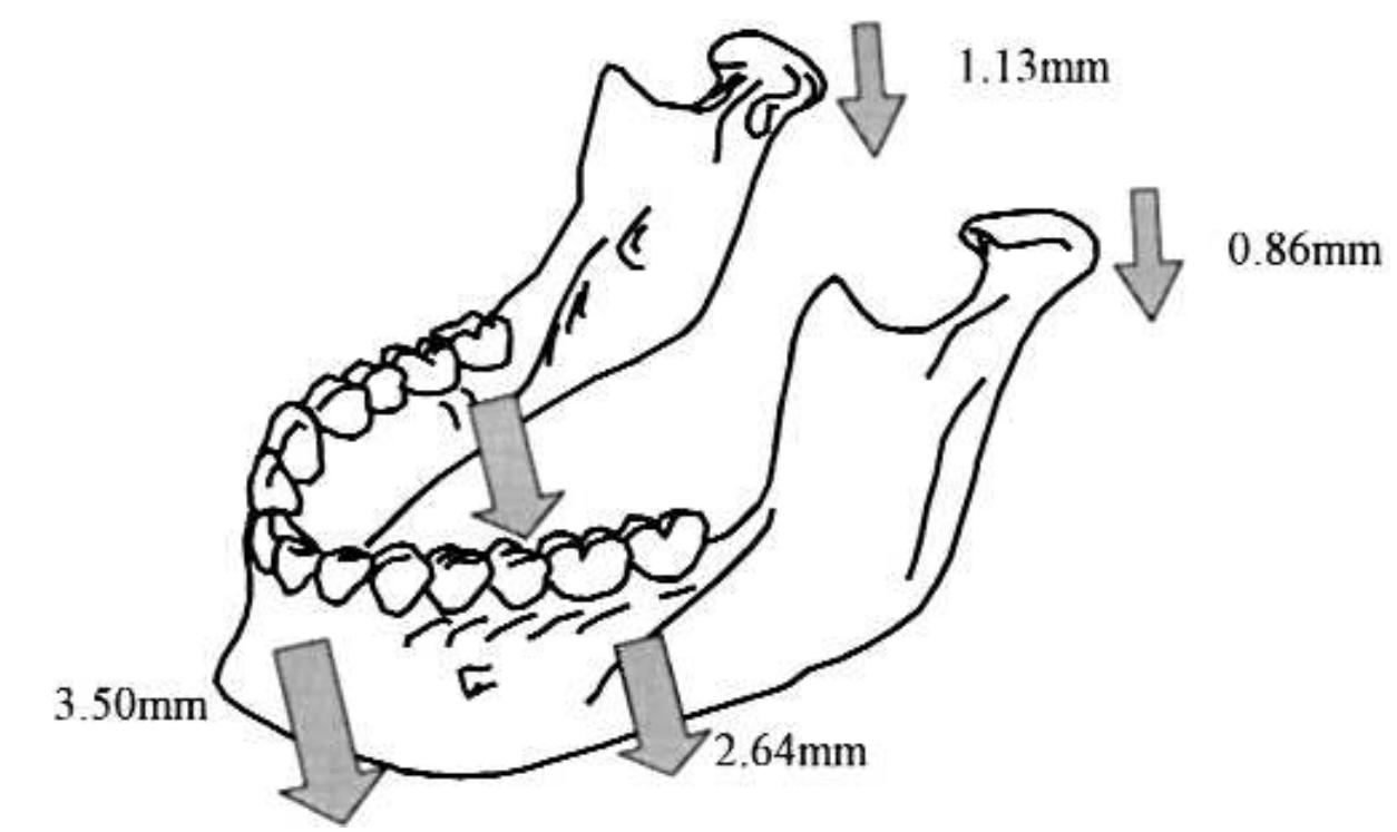 Diagrammatic movements of mandibular landmarks from maximum