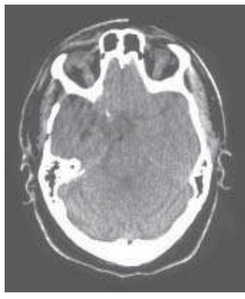 axial view of an axial computorized tomography.