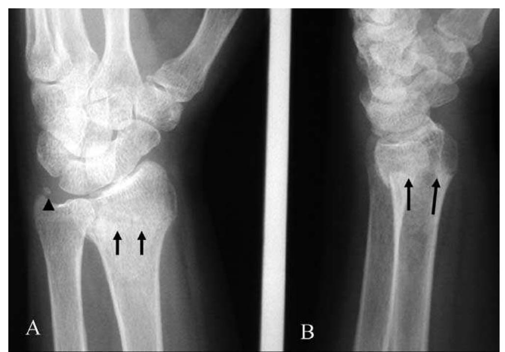 Colles’ fracture. (a) pa oblique and (b) lateral views show