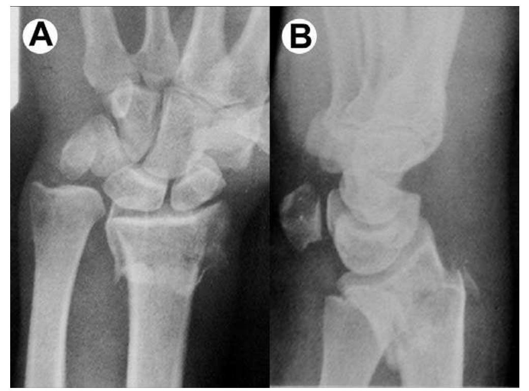 Smith’s fracture. (a) pa view and (b) lateral view of a