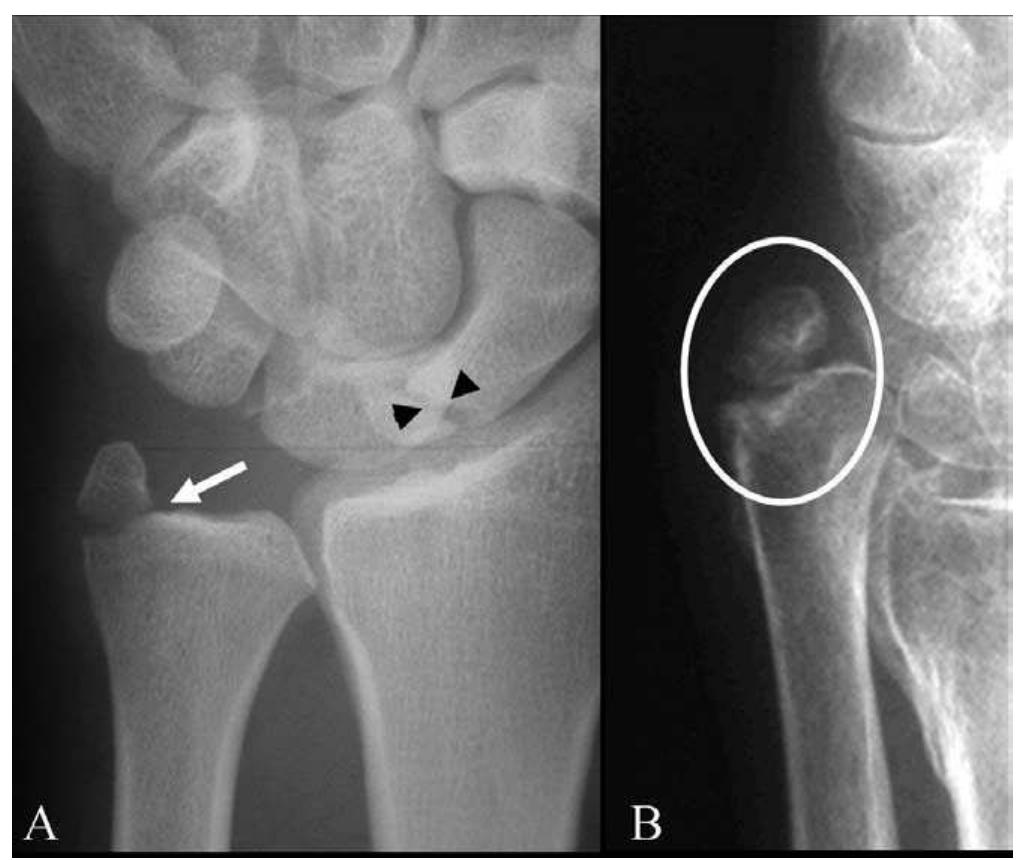 Ulna styloid fractures. (a) pa view shows a fracture of the