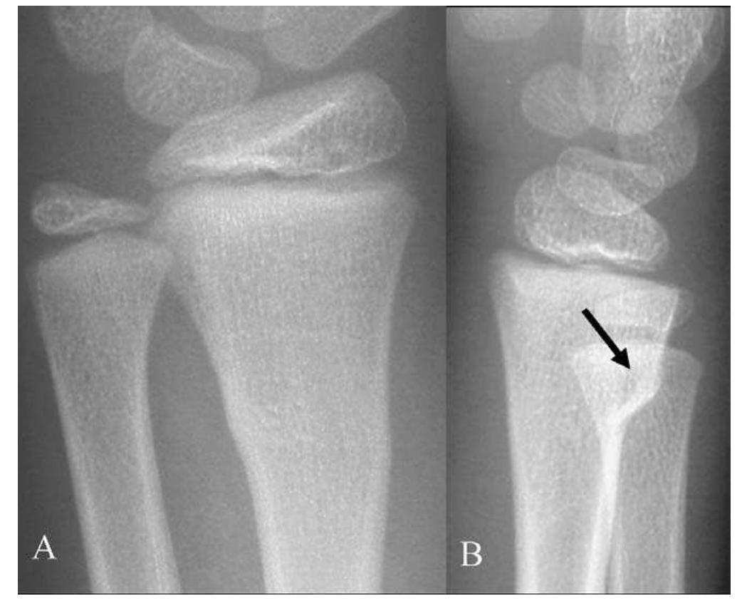 Torus fracture. (a) pa view and (b) lateral views show a