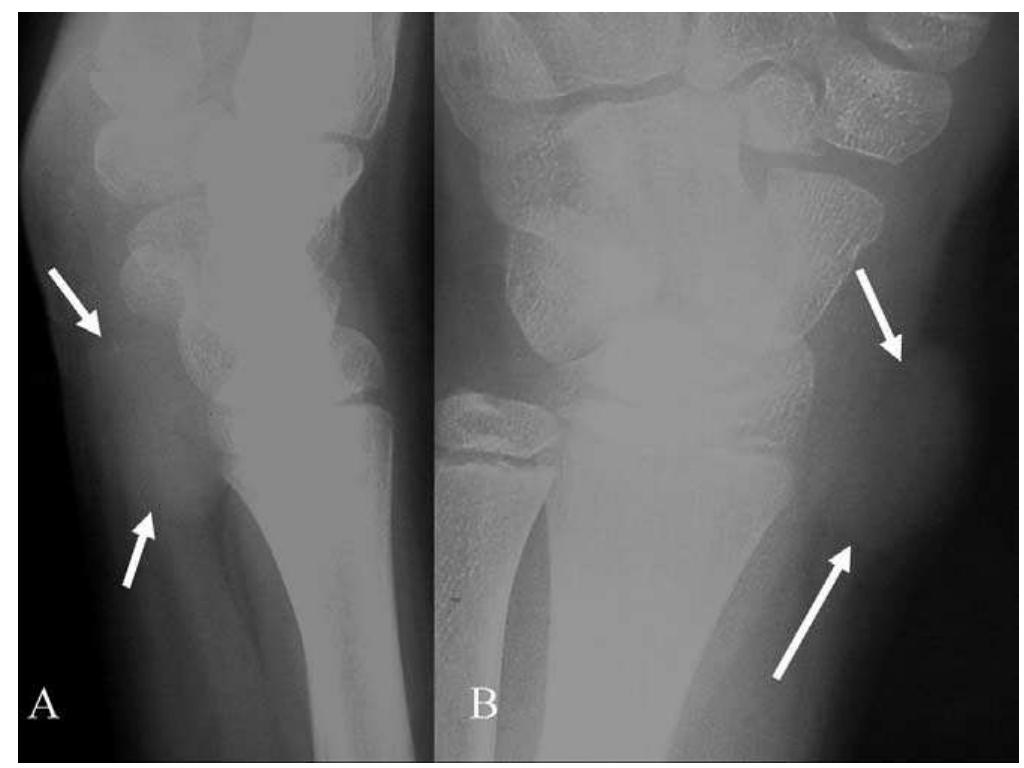 Volar soft-tissue ganglion cyst. (a) lateral and (b) pa
