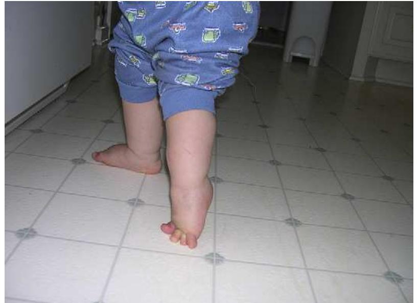 Clinical photograph of a child with left fibular hemimelia.