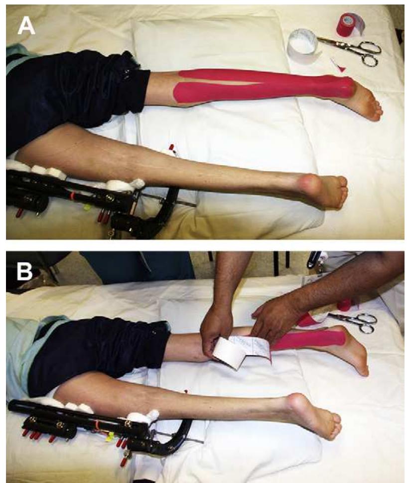 Clinical photographs of kinesiotaping. (a) the latex free