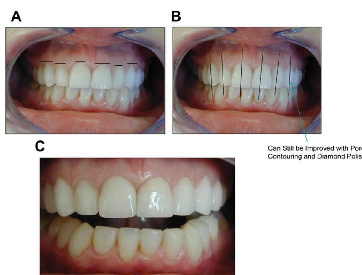 Final restorations showing repair of the (a) gingival
