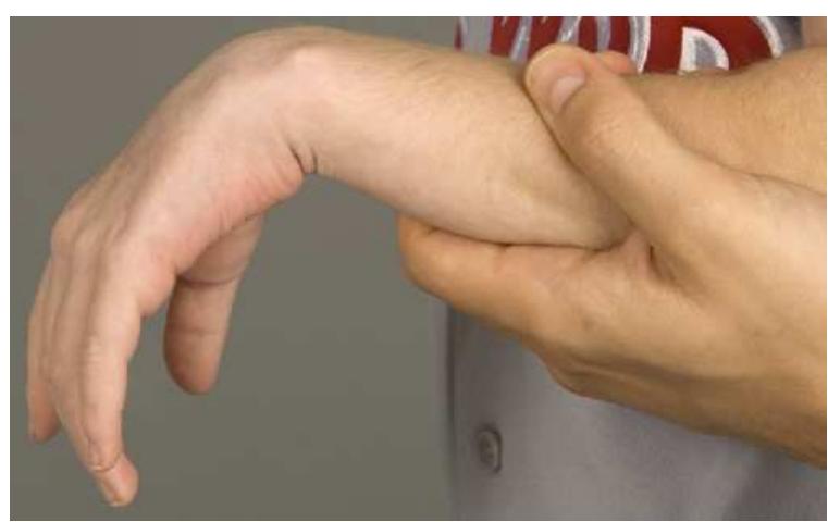 A 7-year-old child’s status after left humerus fracture with