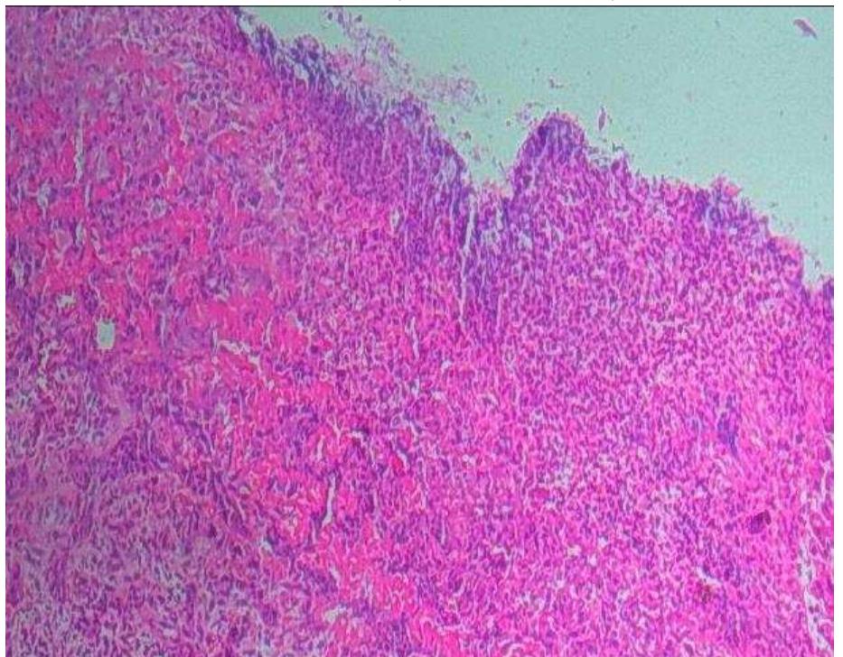 Figure 4 - Recurrent Pyogenic Granuloma in Maxillary