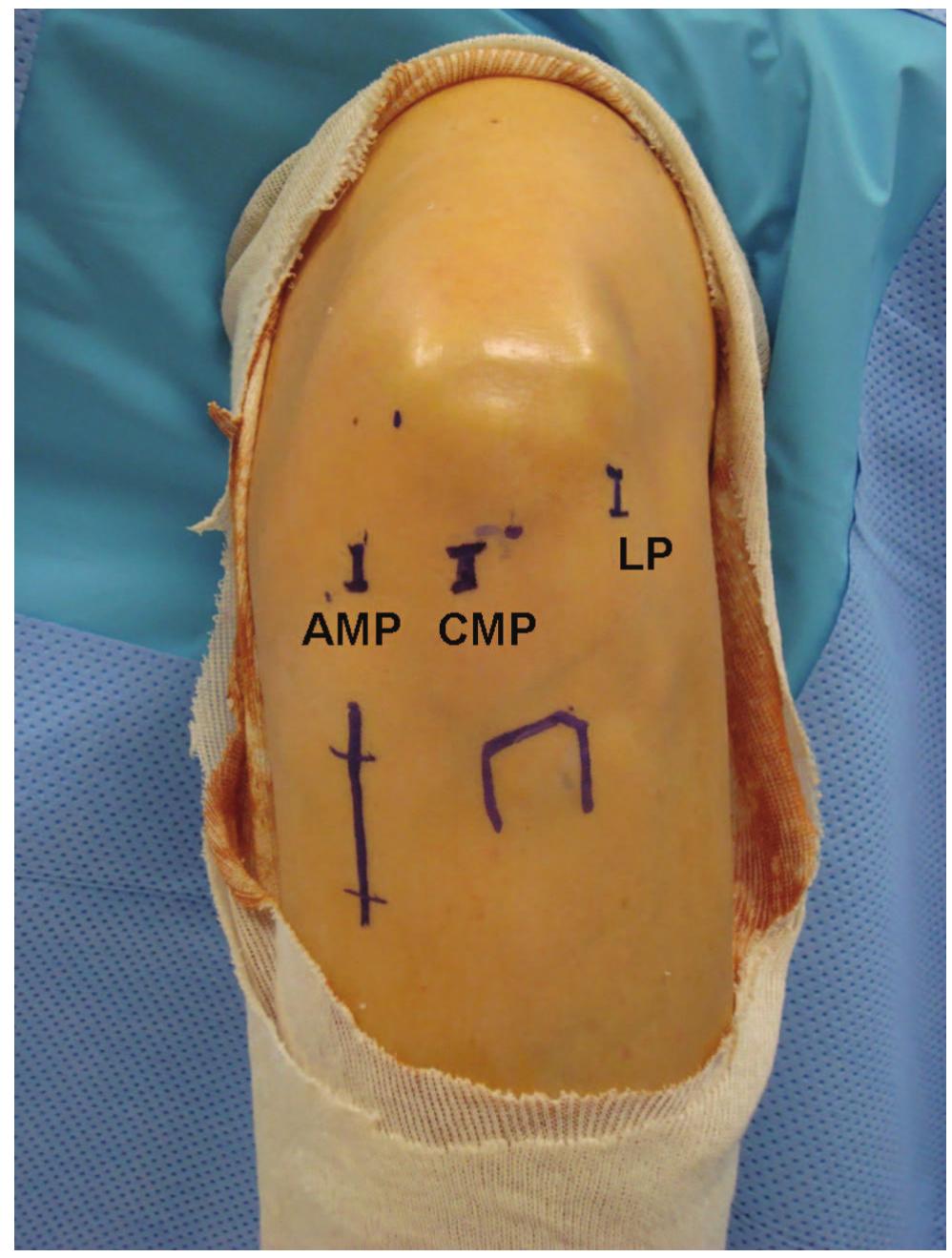 Right knee in 90° of flexion showing the 3-portal technique.