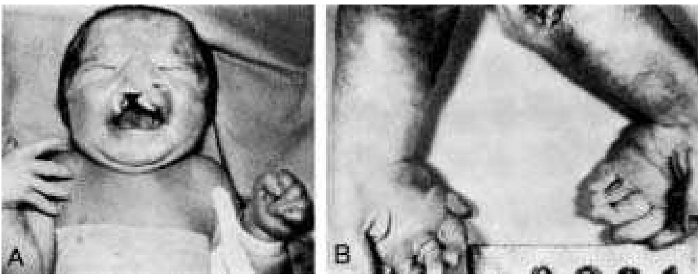 10 a. child with trisomy 13. note the cleft lip and palate,