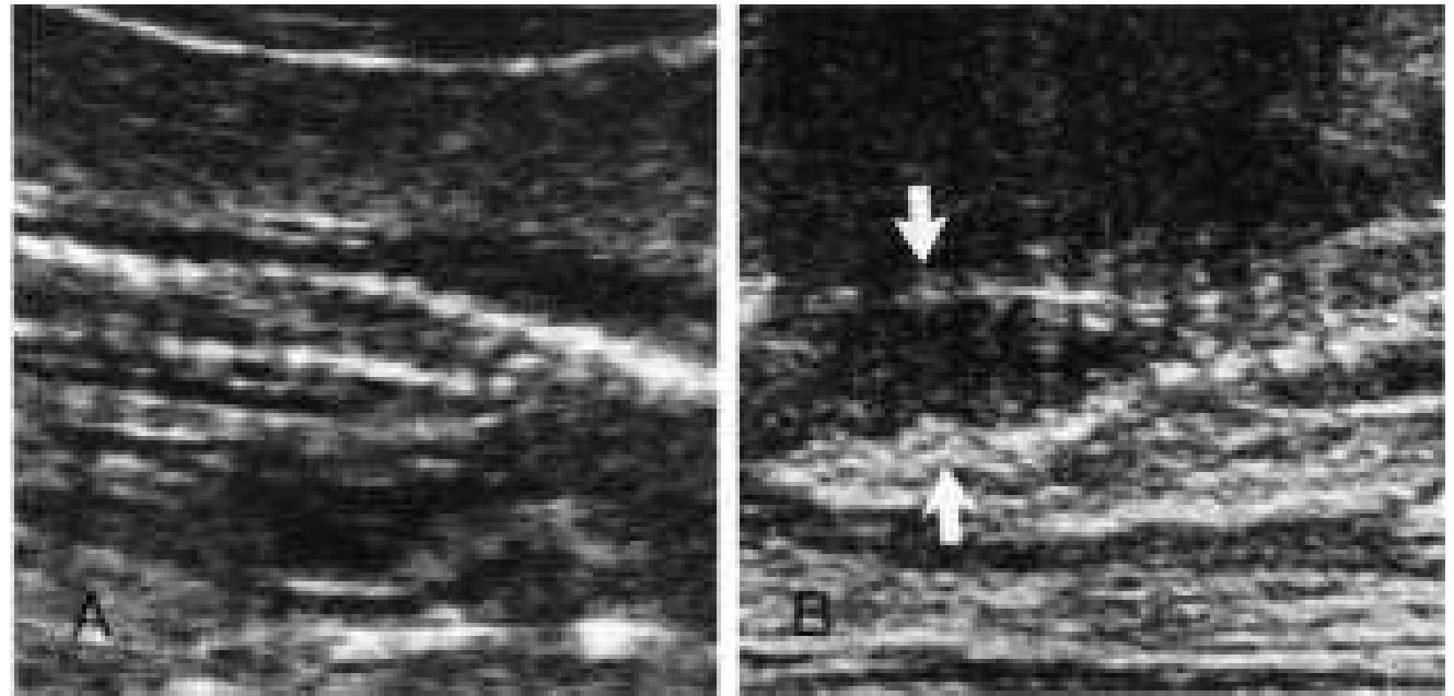 22 ultrasound scans of the vertebral columns in a normal