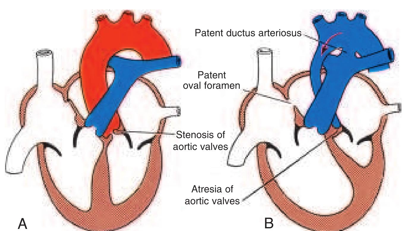 32 a. aortic valvular stenosis. b. aortic valvular atresia.