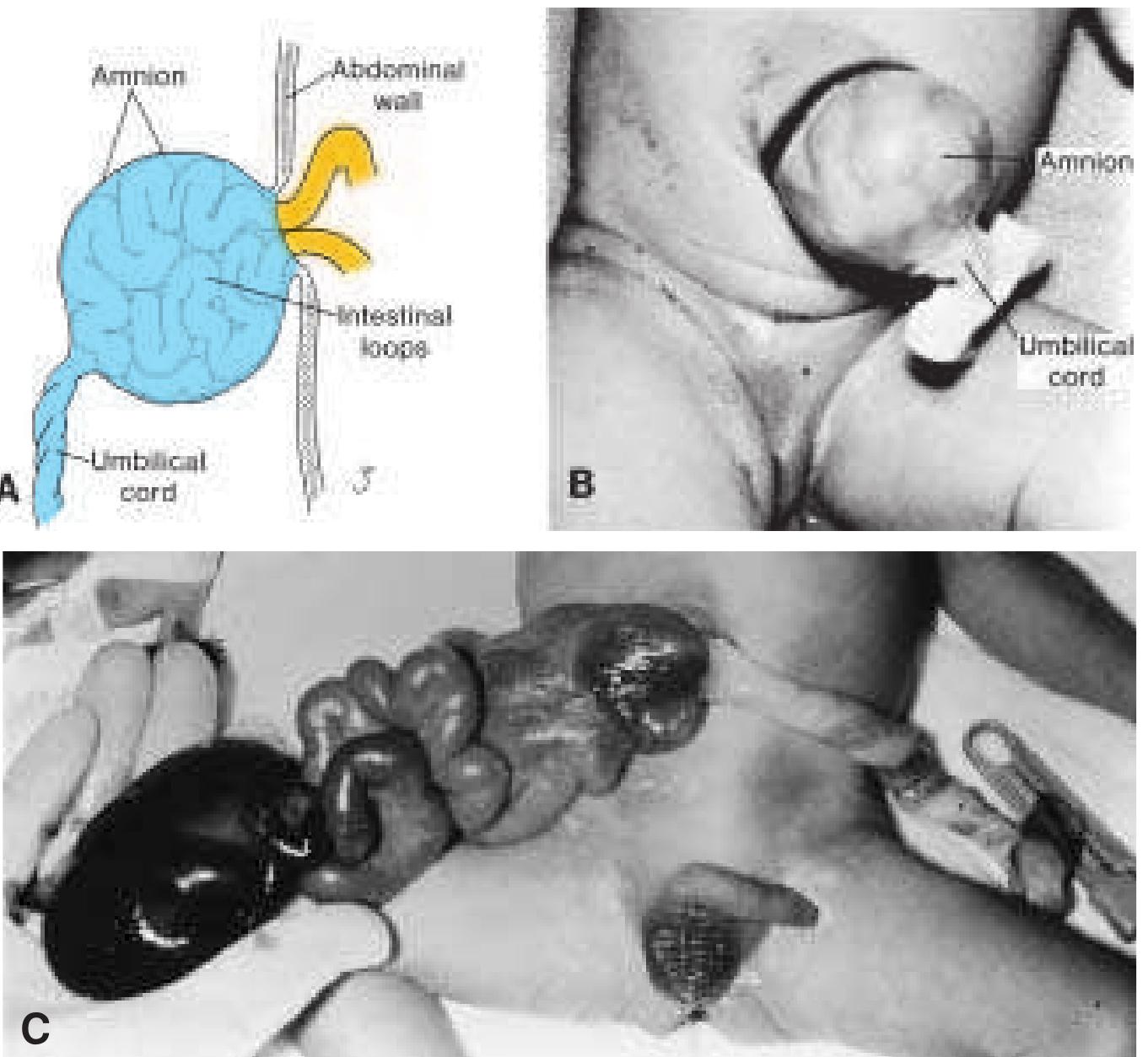 31 a. omphalocele showing failure of the intestinal loops to