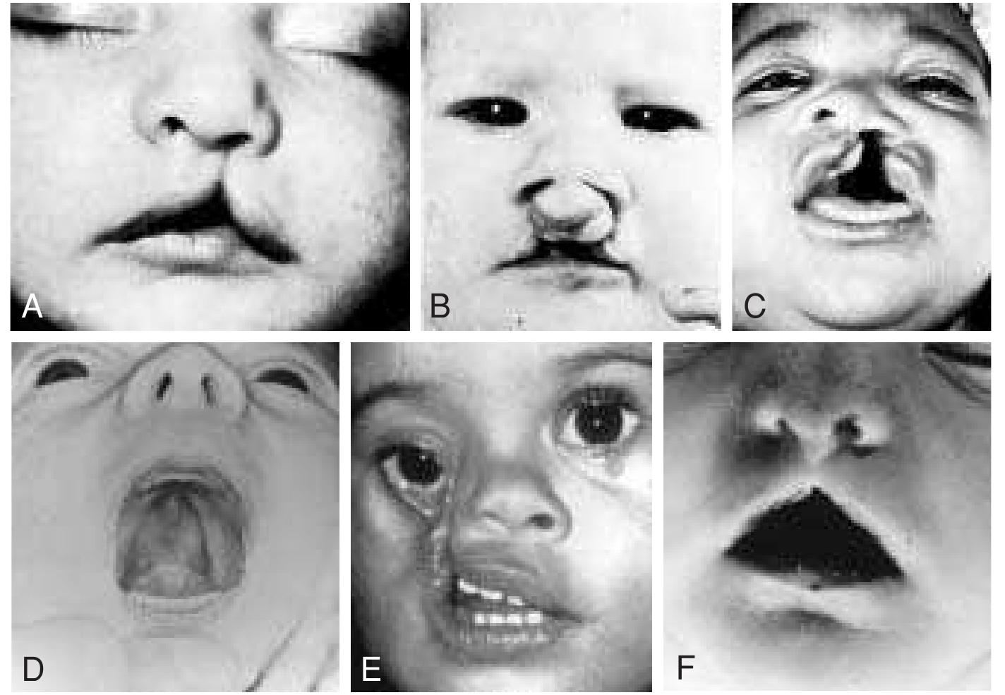29 a. incomplete cleft lip. b. bilateral cleft lip. c. cleft