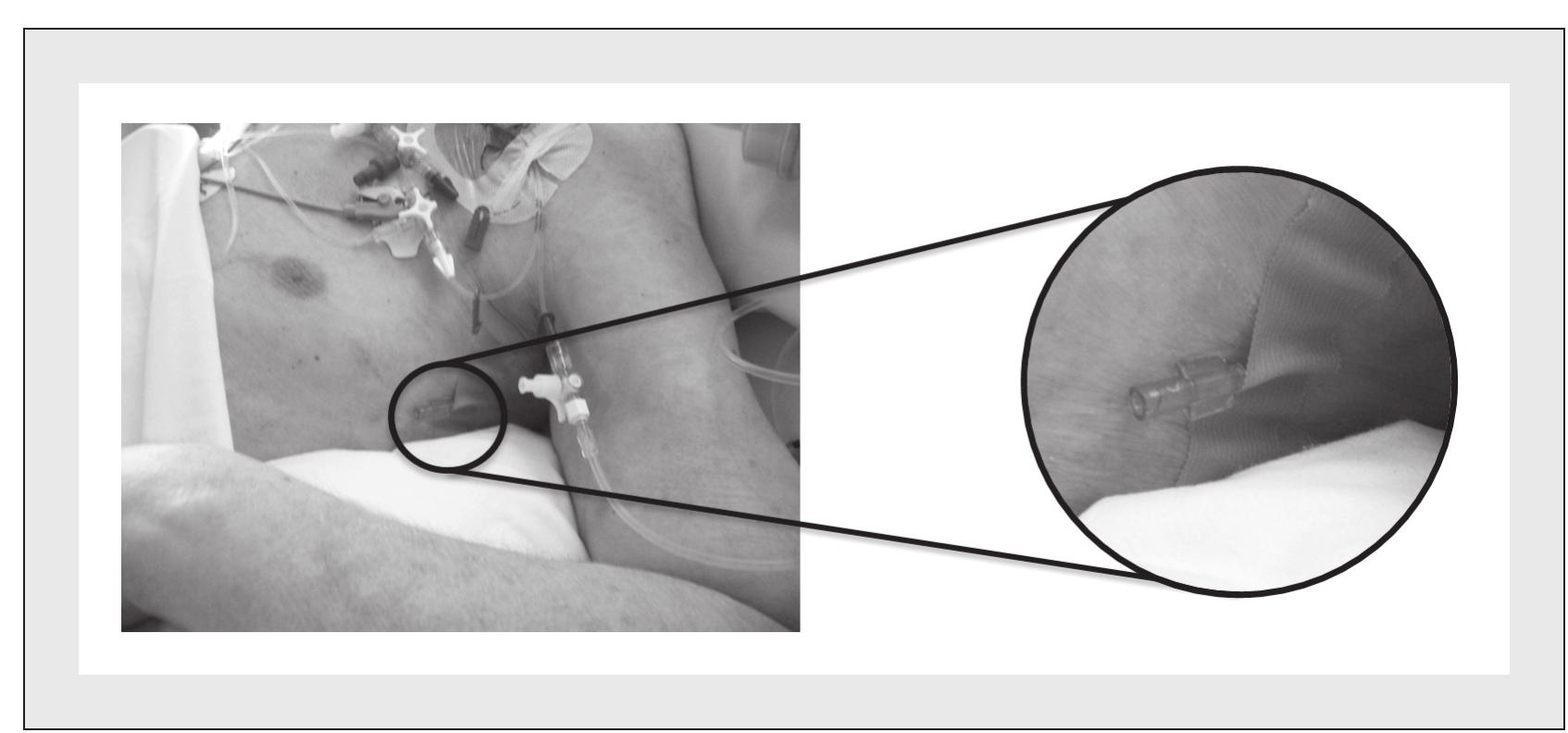 Zero calibration line fixed at the level of the theoretic