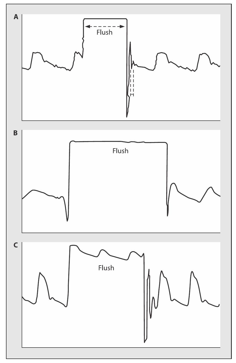 Rapid flush test. adapted from marino, paul l, the icu book,