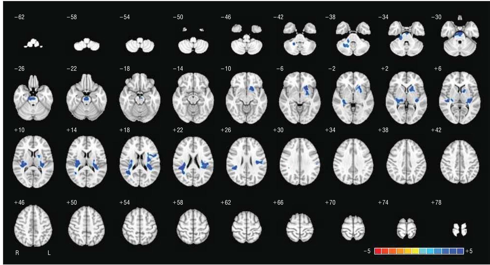 Brain map (voxel-based morphometry) of significant white