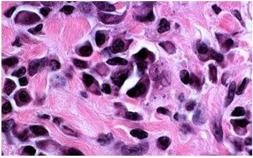 Plate-5 histiocytes (h) a neutrophils (n) and lymphocytes
