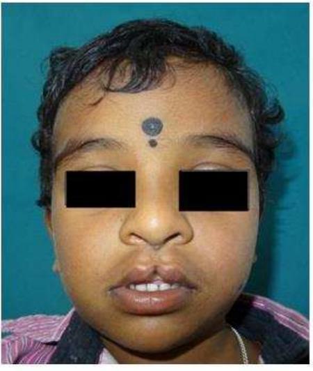 Median cleft of the upper lip | dent (tehran) er the cleft