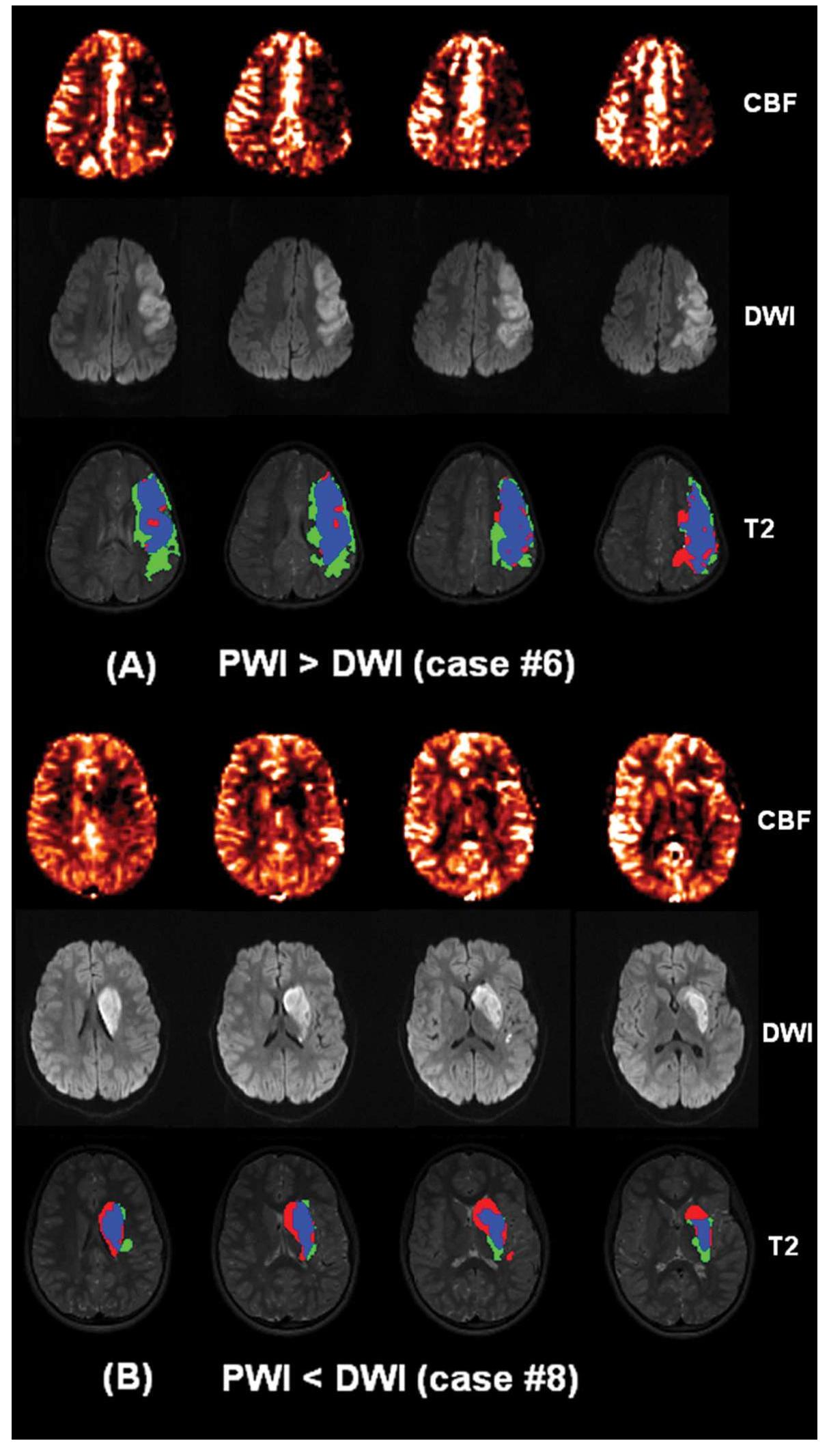 Figure 2 - Arterial spin labeling perfusion MRI in pediatric