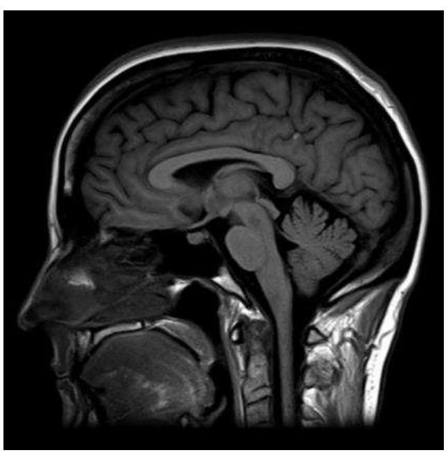Normal midline brain mri [3]. ii. the use of mri in