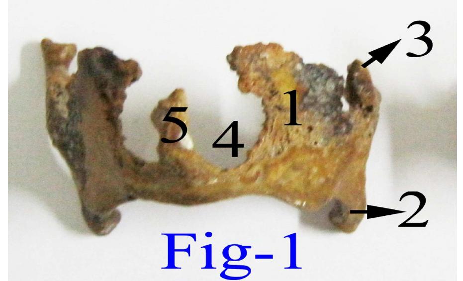 Ossified thyroid cartilages-anterior view 1. lamina. 2.