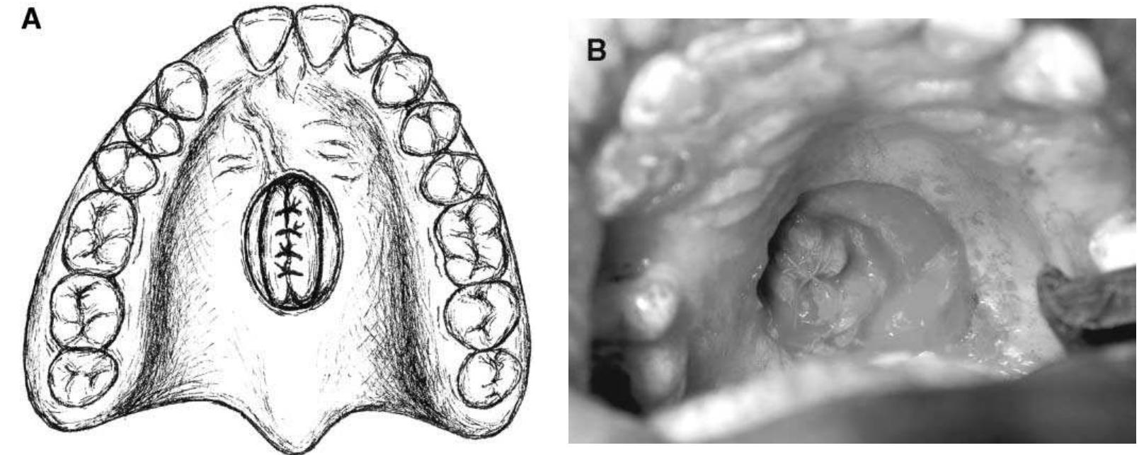 (a,b) turnover flaps sutured to create the nasal floor.