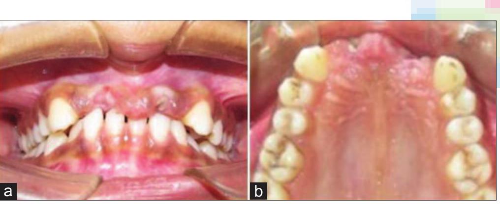 Pretreatment intraoral photograph; (a) frontal view; and (b)