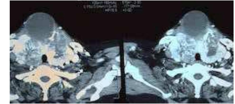 -b: ct scan neck and chest figure 2-a: ct scan neck and