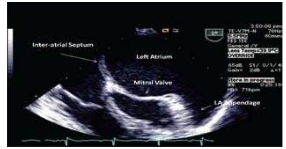 Image 1: 2 d image showing left atrial appendage*