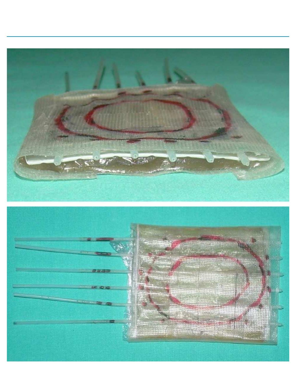 4: hand-made flaps using 5mm bolus and plastic tubes taped