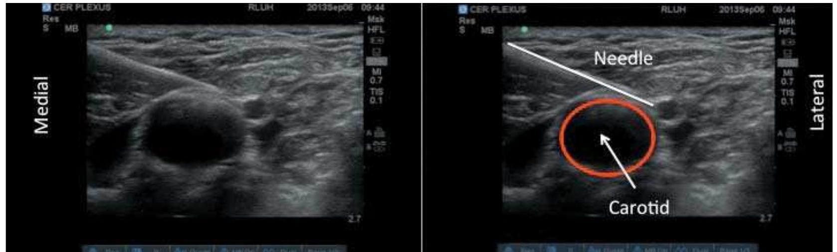 Figure 12 - The cervical plexus: anatomy and ultrasound