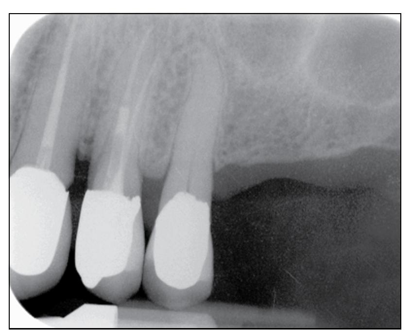 A radiograph of a fractured maxillary first premolar with a