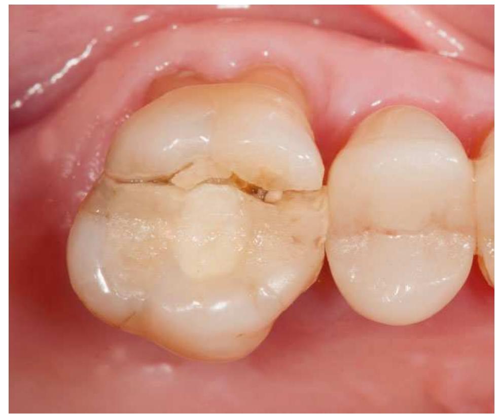Fracture of the palatal cusp of a maxillary right first