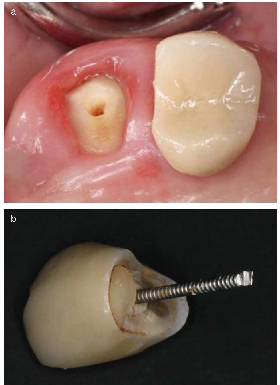 Post and crown loosened from maxillary canine a few months