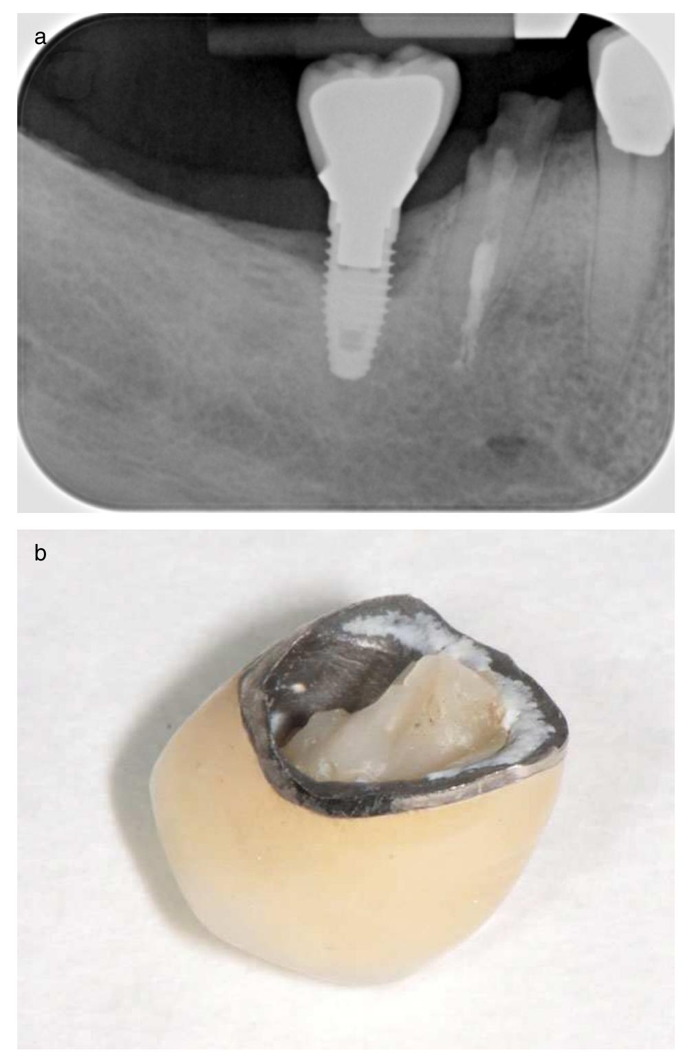 (a) a radiograph of a fractured mandibular second premolar