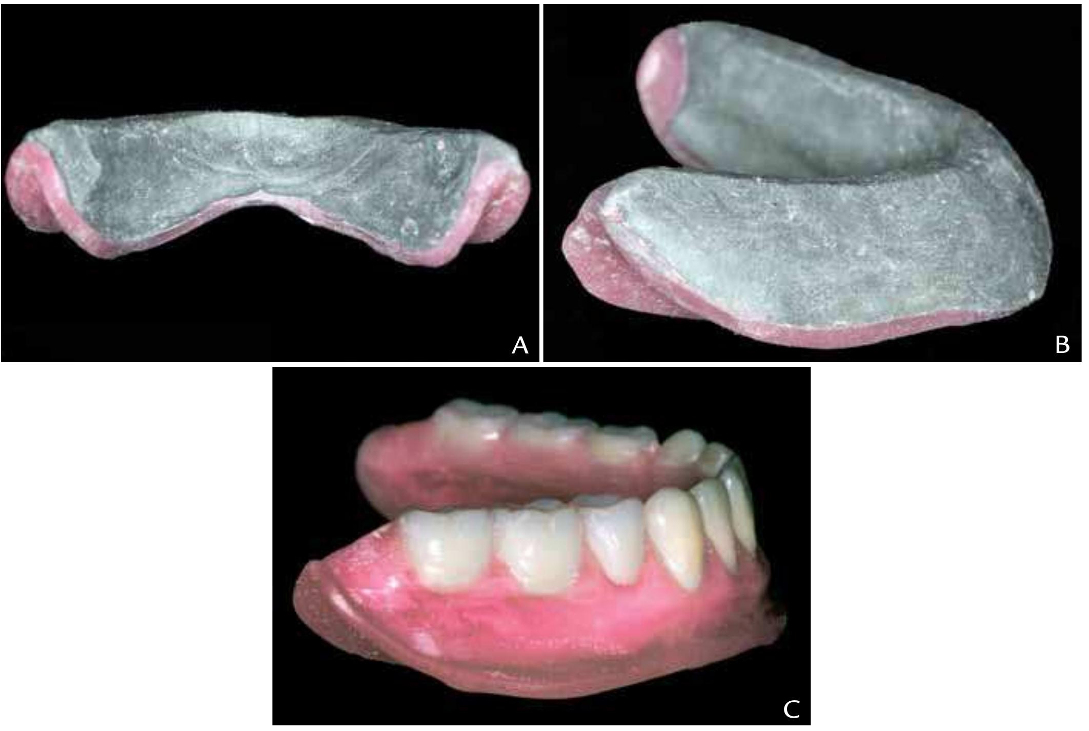Completed mandibular neutral zone record from: a, lingual,