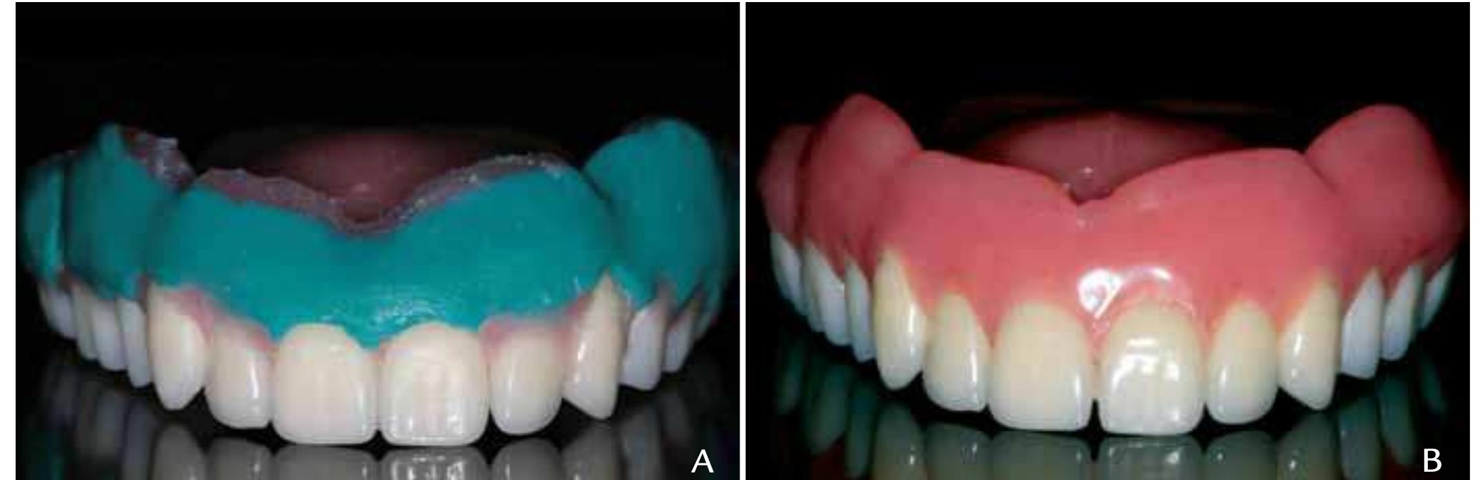 [j denture polished surface contour represented by: a,