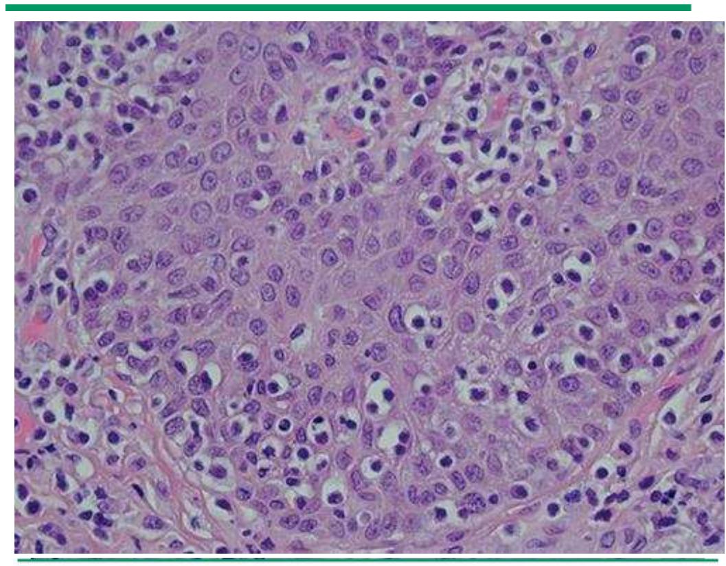 Haloed lymphocytes of mycosis fungoides skin biopsy from a